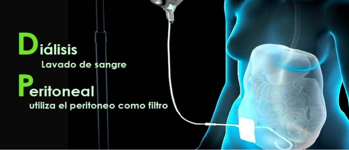 Cómo Funciona La Diálisis Peritoneal – ZZGH